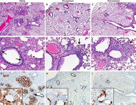 Pathological Analysis Of The Lung Tissue Hematoxylin And Eosin Hande
