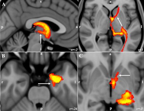 Population Connectivity Maps Of The Amygdala Clusters A The Basal