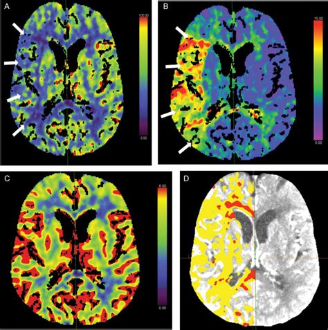 Computed Tomography Perfusion Brain Parametric Maps Clockwise From Download Scientific Diagram
