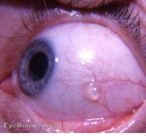 Conjunctival Disease Flashcards Quizlet