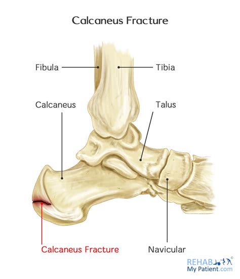 Calcaneus Fracture Rehab My Patient