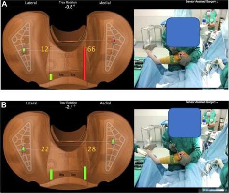 Hugo C Rodriguez Do Mbs On Linkedin Medial Varus Proximal Tibial