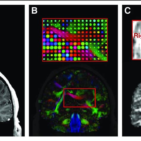 diffusion tensor imaging dti visualization and quantification in