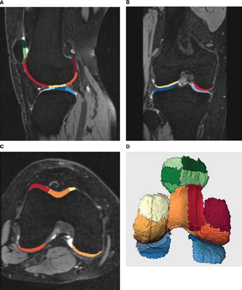a d shows the post processing results of knee cartilage segmentation