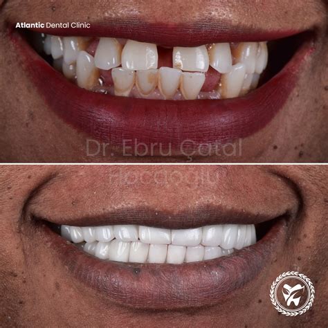 Bite Correction Atlantic Dental Clinic