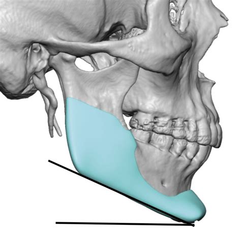 The Use Of Mandibular Plane And Gonial Angle Measurements In Custom