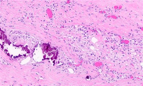 Pathology Outlines Morel Lavallée Lesions