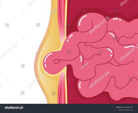 Internal Organs Abnormal Condition Choked Hernia Stock Vector Royalty