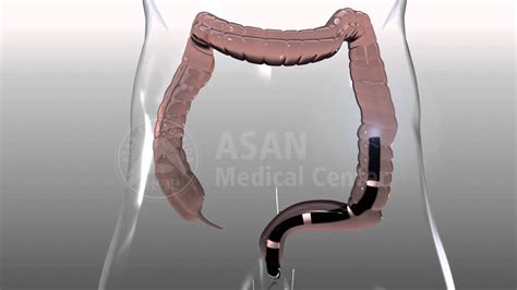 Sigmoidscopy Youtube