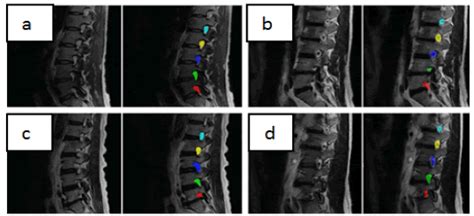 Artificial Intelligence Machine Learning And Deep Learning In Neuroradiology Current Applications