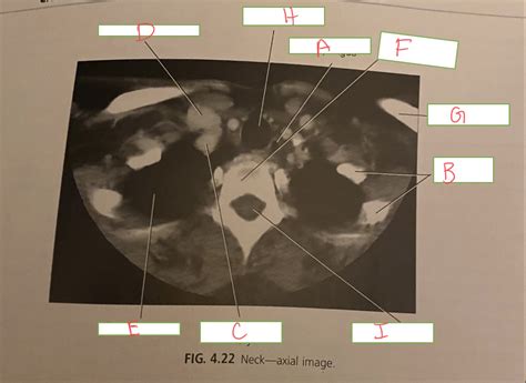 Ct Soft Tissue Neck Axial 3 Diagram Quizlet
