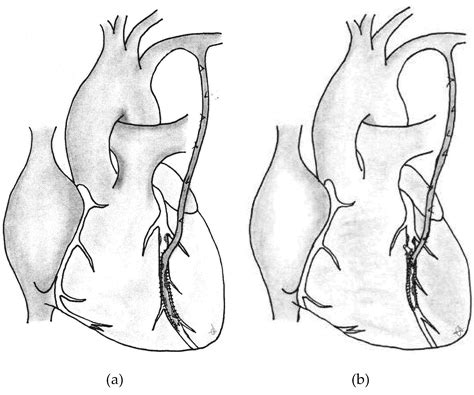Surgical Treatment In Diffuse Coronary Artery Disease IntechOpen