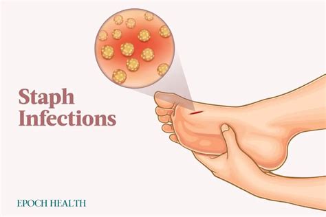 Staph Infection The Epoch Times