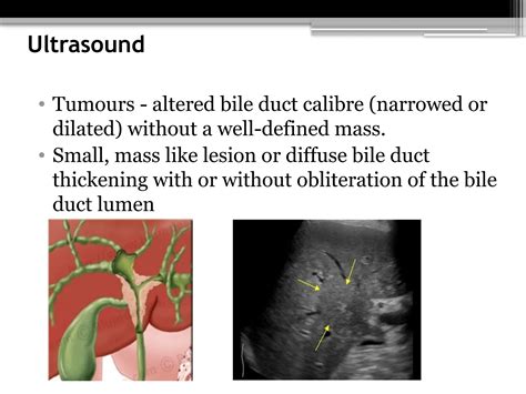 Cholangiocarcinoma Sudhan Radiological Imaging Ppt