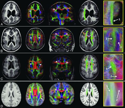 thickened superior fronto occipital fasciculus t1wi direction encoded