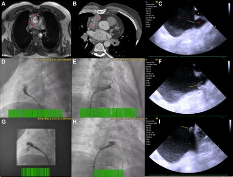 Right Atrial Leadless Pacemaker After Glenn Repair Cjc Pediatric And