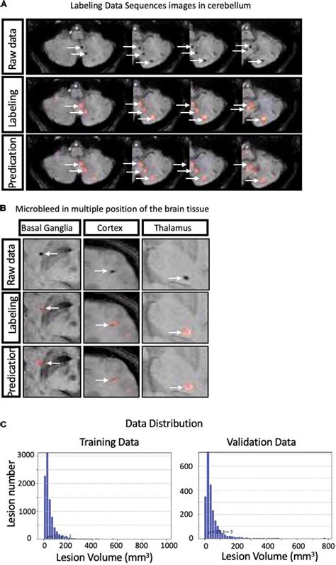 Representative Cases Of Manual Cerebral Microbleeding Cmb Labeling Download Scientific