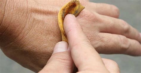 საუკეთესო ინგრედიენტი მეჭეჭების მოსაშორებლად ყველაზე ეფექტური და სწრაფი ხერხია