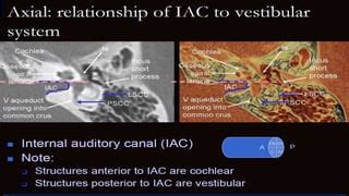 Ct Temporal Bone PPTX