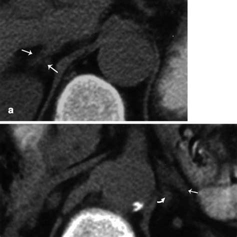 A 55 Year Old Woman With Primary Hyperaldosteronism Due To Nodular Download Scientific Diagram