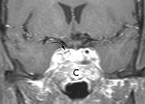 Cavernous Sinus