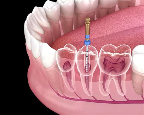 Root Canal Treatment Procedure Step By Step Ppt At Laura Burke Blog