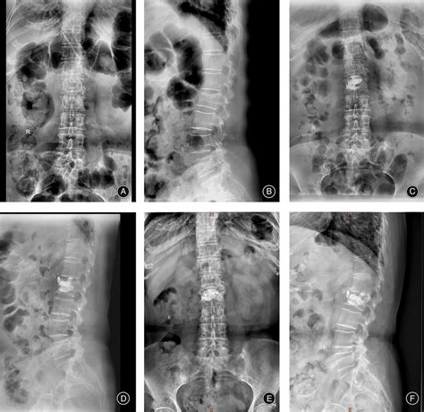 The Imaging Data Of A 75‐year‐old Woman Showed L2 Vertebral Compression Download Scientific