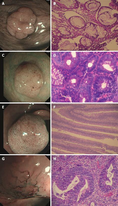 Endoscopic Diagnosis Of Colon Polyps Using The Nice