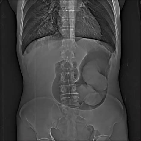 Retrograde Jejunogastric Intussusception Case Reports In Clinical Radiology