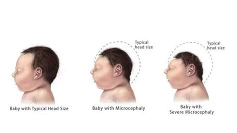 Autosomal Recessive Primary Microcephaly Medlineplus Genetics