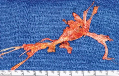 Pulmonary Thromboendarterectomy For Pulmonary Hypertension Before