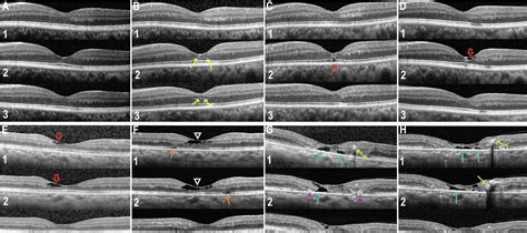 Update On Macular Telangiectasia Type 2 Mactel