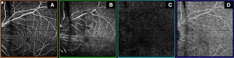 Macular OCTA 6 6 Mm Superficial Vascular Plexus A Deep Vascular Download Scientific