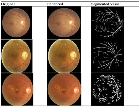 Automatic Detection Of Diabetic Hypertensive Retinopathy In Fundus Images Using Transfer Learning
