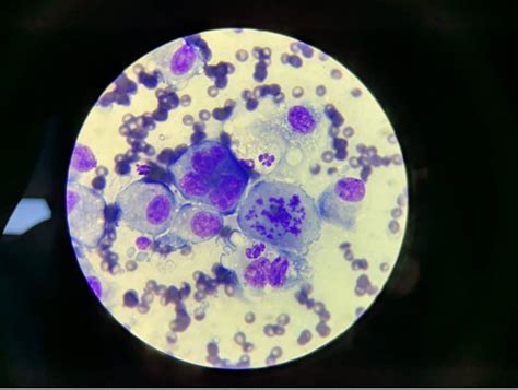 Histocytic Sarcoma Cytology Sarcoma Eclinpath
