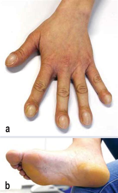 Clubbing Of Fingers And Nails In Primary Hypertrophic Osteoarthropathy