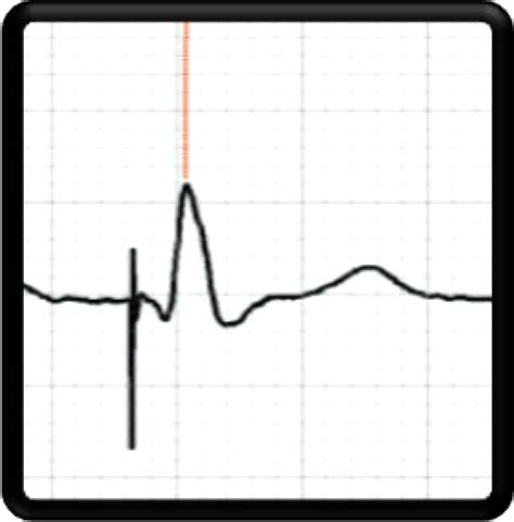 Left Bundle Branch Area Pacing A New Era Of Cardiac Resynchronization Therapy