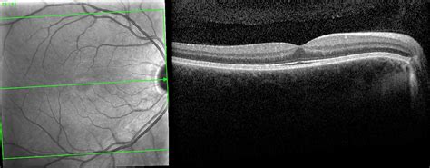 Macular Edema Remedies Review Of Treatment Options