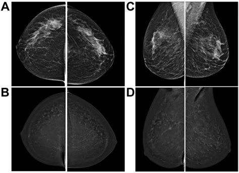 Parenchymal Enhancement