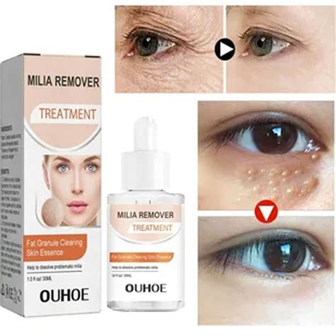 Professional Milia Seed Remover And Fat Granule Syringoma Treatment