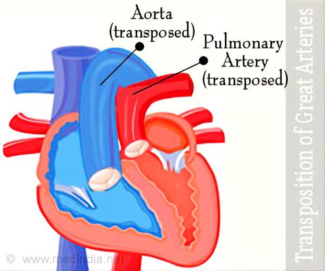 Transposition Of Great Arteries Psvi