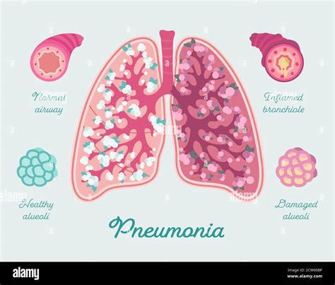 Pneumonia Symptoms Lungs