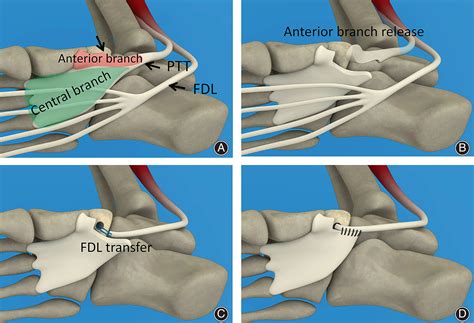 A Novel Anatomic Reconstruction For Posterior Tibialis Tendon In