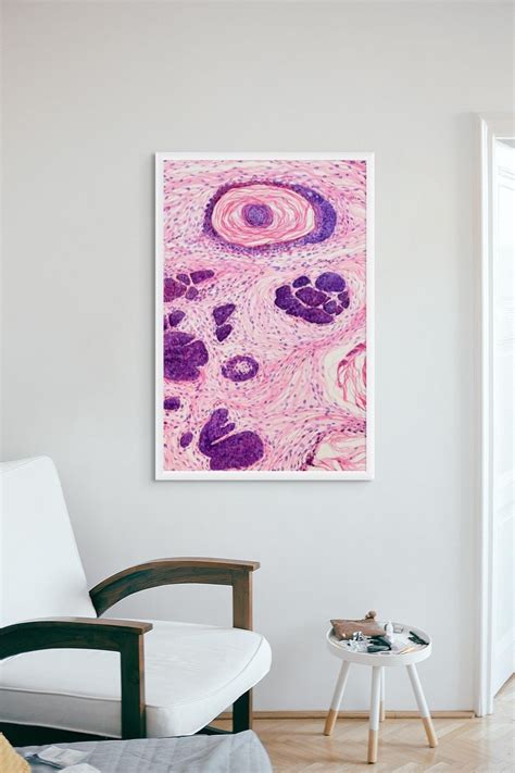 Basal Cell Carcinoma Histology Art Print Etsy