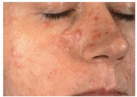 Leukemia Cutis 6