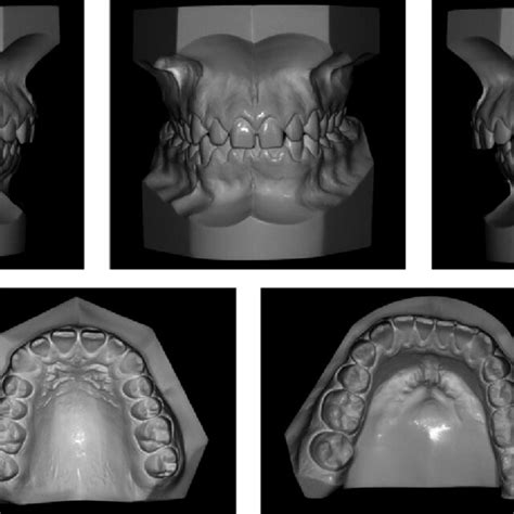 Pdf An Orthodontic Surgical Approach To Class Ii Subdivision