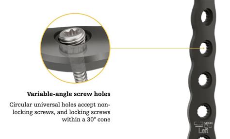 Pangea™ Distal Anterolateral Tibia Plate Implants Orthobullets