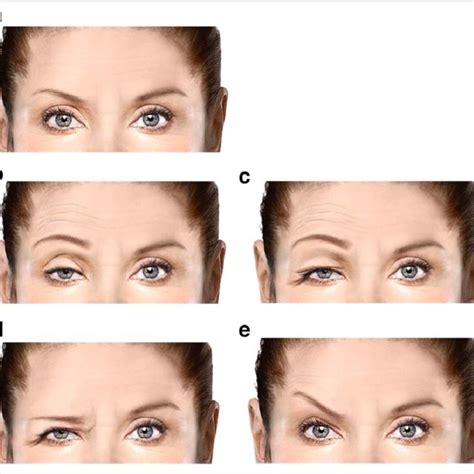—fixed Site Fixed Dose Preempt Injection Site Locations A Download Scientific Diagram