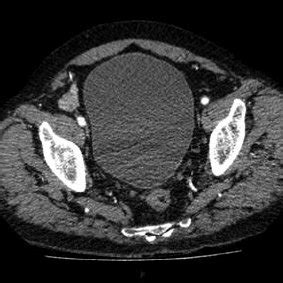 The Initial Ct Scan Of The Abdomen Showing A Large Distended Bladder