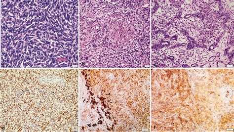 Mixed Sex Cord Stromal Tumor Gynandroblastoma With Malignant Morphology Involving Both Ovaries
